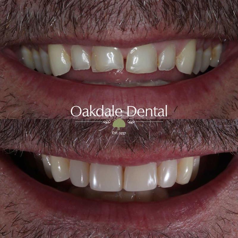 Before & After Dental Treatment Photos | Oakdale Dental Leicester