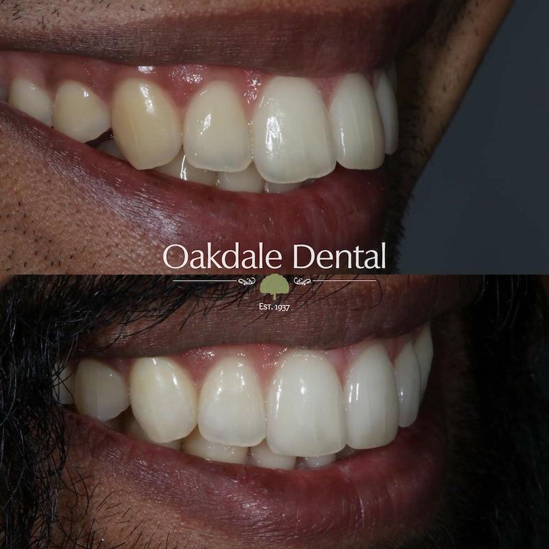 Before & After Dental Treatment Photos | Oakdale Dental Leicester
