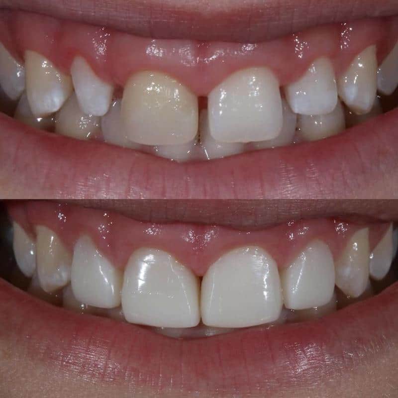 Before & After Dental Treatment Photos | Oakdale Dental Leicester