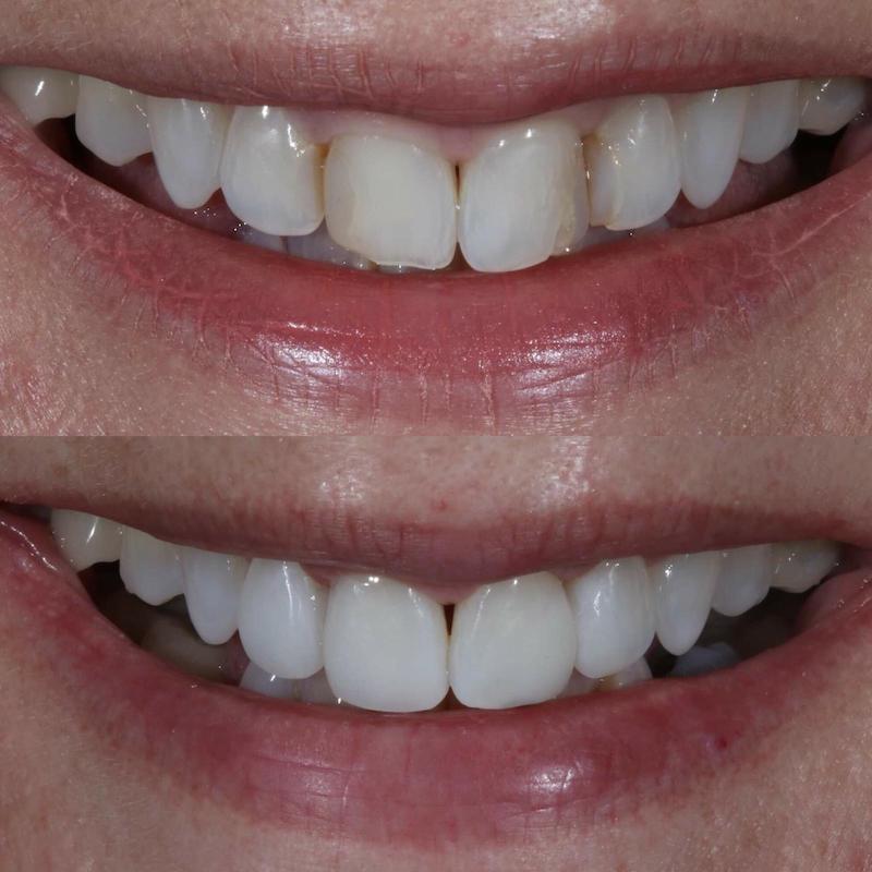 Before & After Dental Treatment Photos | Oakdale Dental Leicester