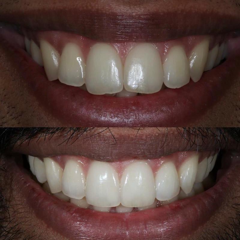 Before & After Dental Treatment Photos | Oakdale Dental Leicester