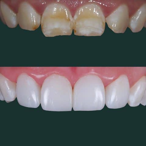 Teeth Bonding Leicester | Contouring Leicester | Quick Teeth Repair